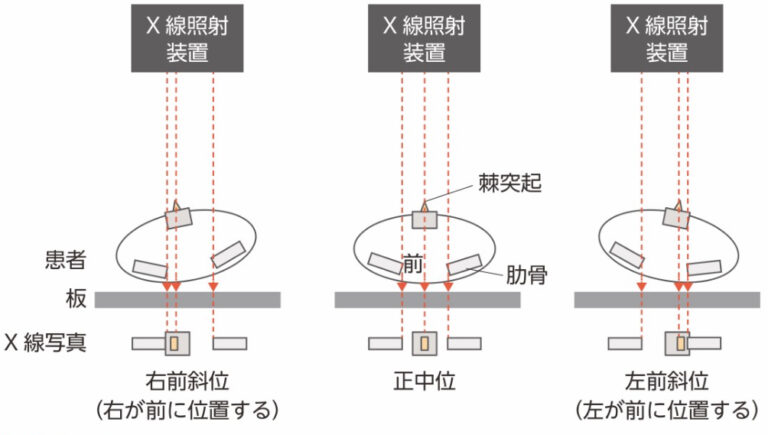 胸部X線（CXR）、腹部X線（AXR） | くすり～の